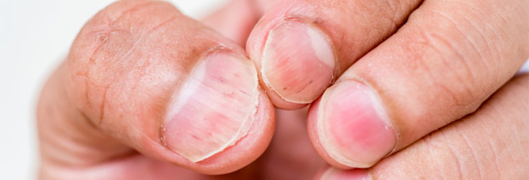 Guide en ligne pour soigner le psoriasis des ongles